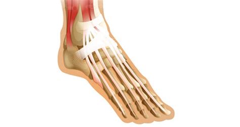 Extensor Tendonitis Foot Foot Symptoms And Treatment