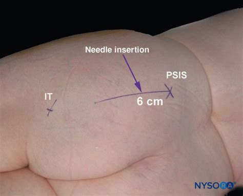 Sciatic Nerve Block Landmarks And Nerve Stimulator Technique Nysora
