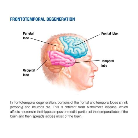 Frontal Lobe Dementia Symptoms