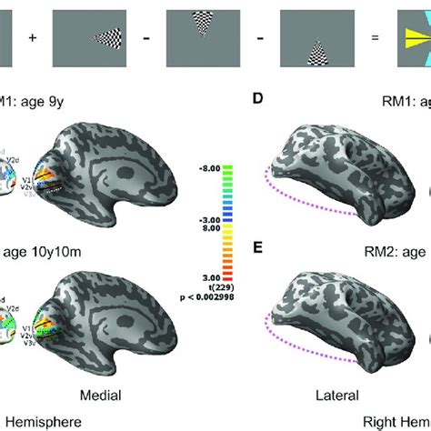 Early Visual Cortex Activation In Ud In Rm1 Age 9 Years And Rm2 Download Scientific Diagram