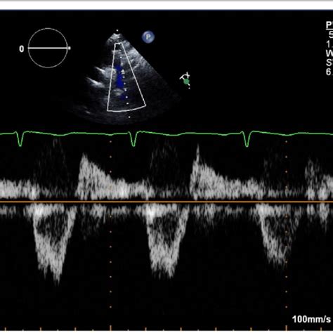 Transthoracic Echocardiography Suprasternal View With Pulsed Doppler Download Scientific
