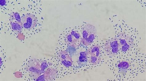 A Non Invasive Test Enables Accurate Detection Of Infant Meningitis