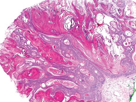 Dark Brown Macule On The Periumbilical Skin Mdedge