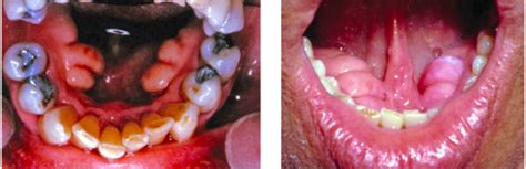 Oral Soft Tissue Lesions Flashcards Quizlet