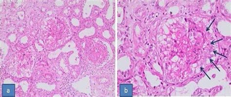 Collapsing Glomerulopathy In A Patient With A Trpc6 Mutation Saudi
