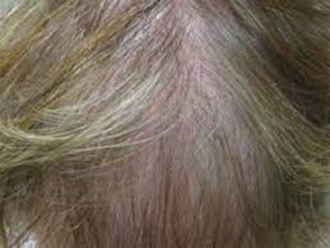 Diffuse Unpatterned Alopecia Causes Symptoms Treatment