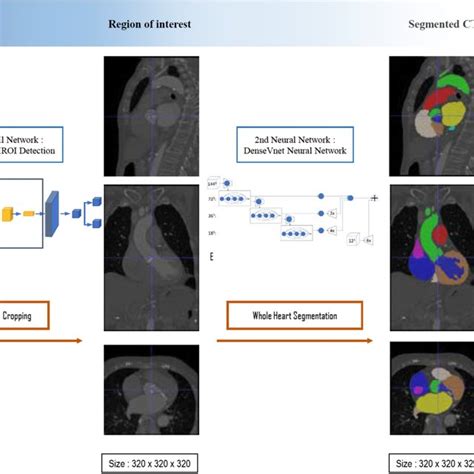 Deep Learning Based Whole Heart Segmentation Workflow A Native