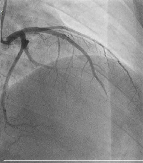 Coronary Angiography LAO Cranial View Showing Good Flow In LAD After Download Scientific