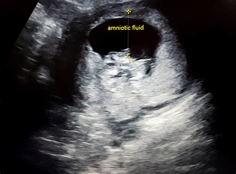 Amniotic Fluid