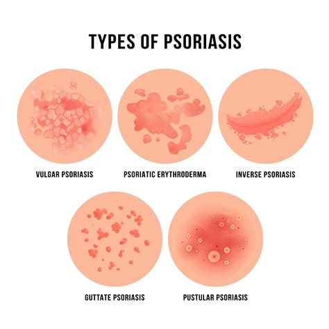 Psoriasis Skin Rash On Face