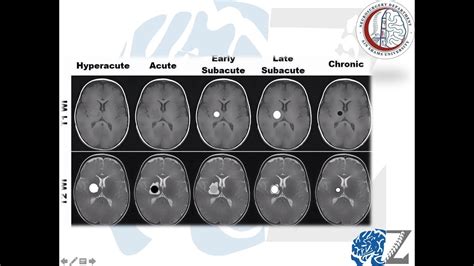 Blood In Mri Brain Youtube