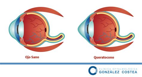 ¿qué Es El Queratocono Causas Y Tratamiento