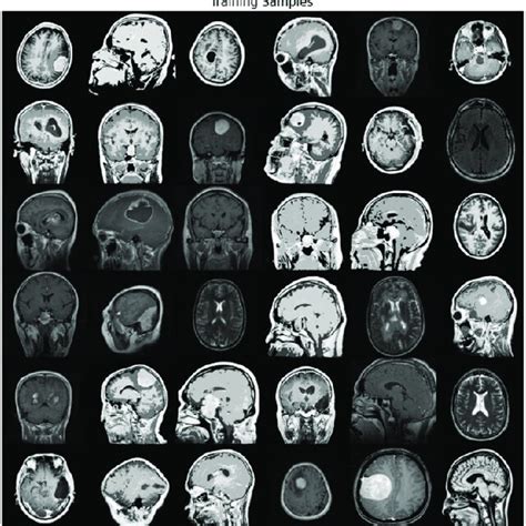 The Sample Images In The Brain Tumor MRI Dataset Download Scientific Diagram