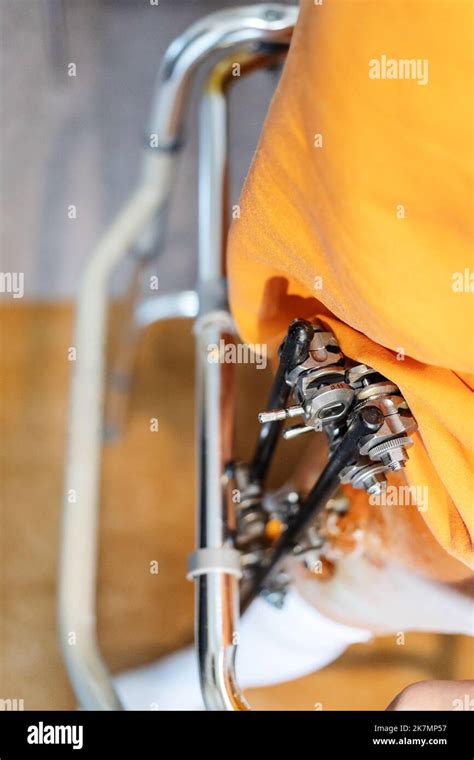 Above View Of External Fixation Device On Hip And Pelvic In Patient With Pelvic Fracture