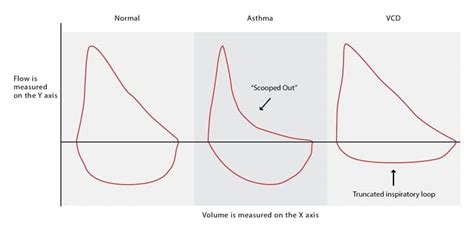 Asthma Or Vocal Cord Dysfunction Respiratory Therapy
