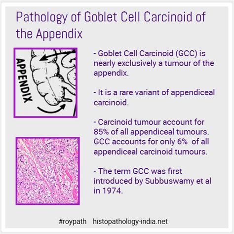 Educational  Pathology Of Goblet Cell Carcinoid Of The Appendix