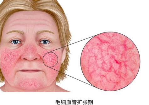 不普通的痤瘡玫瑰痤瘡啥來頭可以怎麼治 每日頭條