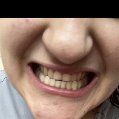 Am I Eligible For Underbite Jaw Surgery My Underbite Is Class 1 But Lately Its R Jawsurgery