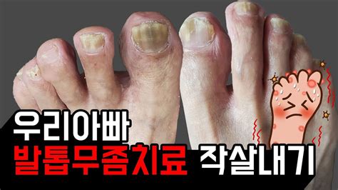 현장직 우리아빠 발톱무좀치료 집에서 도와드리기 발톱무좀약 풋헬퍼 스케일링 Youtube