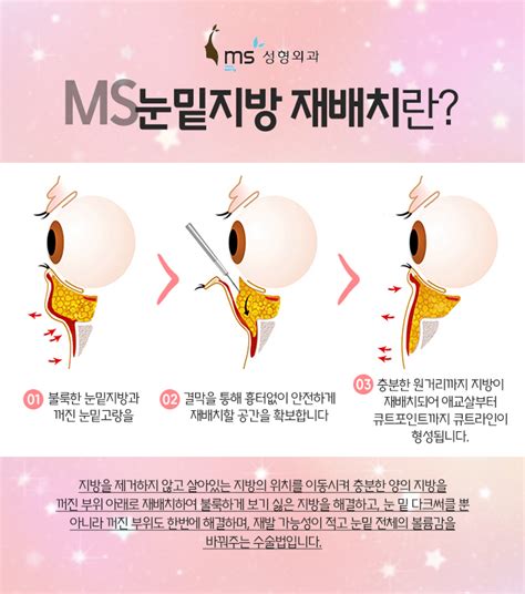 동탄눈밑지방재배치 칙칙하고 피곤해보일 때