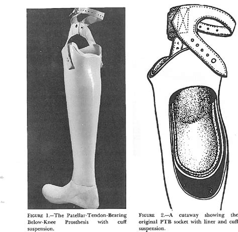 Figure 7 From Variants Of The Ptb Patellar Tendon Bearing Below Knee