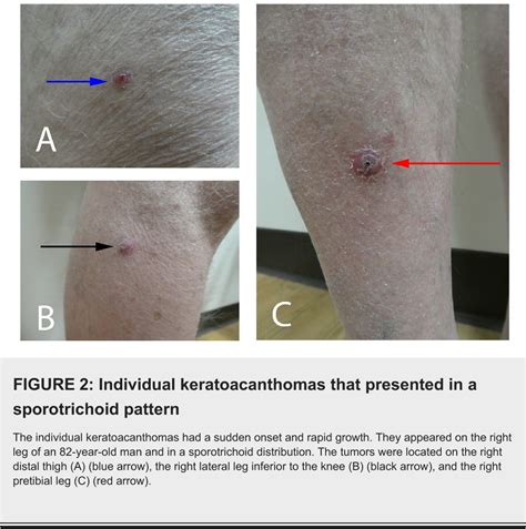 Keratoacanthoma