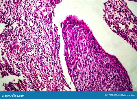 Carcinoma Squamoso Delle Cellule Del Micrografo A Luce Uterina