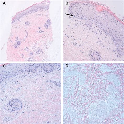 Figure 2 From A Case Of Restrictive Dermopathy With Novel Zmpste24 Gene Mutation Semantic Scholar