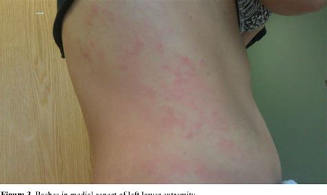 Lamictal Rash