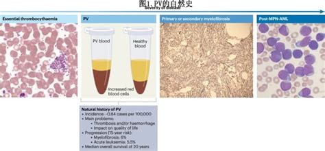 【nature子刊】真性红细胞增多症 Medscicn