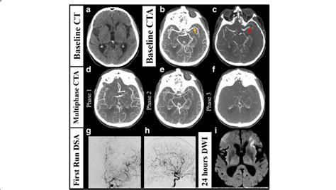 68 Year Old Lady Presented With Acute Left Mca Syndrome With Nihss