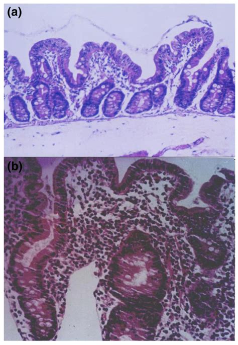 Intestinal Mucosa Showing Environmental Enteropathy A Biopsy Of The Download Scientific