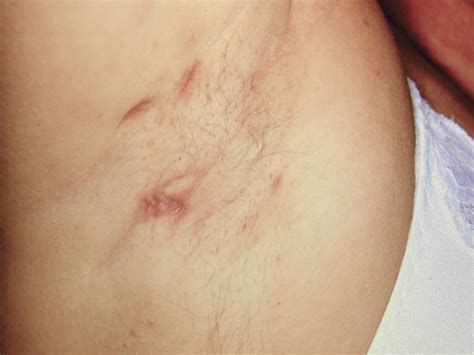 Sebaceous Cyst Bikini Line Sebaceous Cyst Bikini Line
