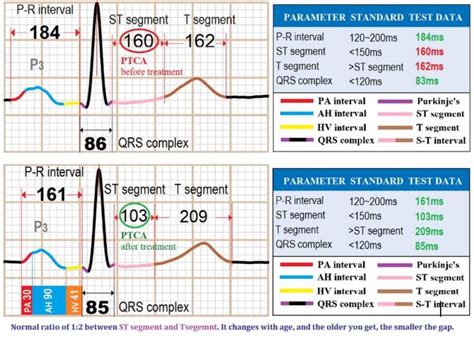 Benny Lau On Linkedin Before And After Ptca Comparison Normal Ratio Of 1 2 Between St Segment…