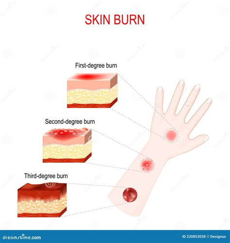 Types Of Burns Cross Section Of Humans Skin Vector Illustration