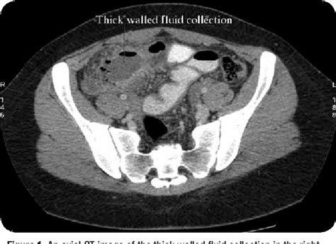 Figure 1 From Ct Guided Percutaneous Drainage Of Appendix Abscess Semantic Scholar