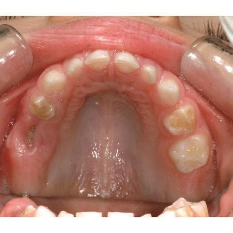 Photograph Showing The Enamel Hypomineralization Affecting The Labial