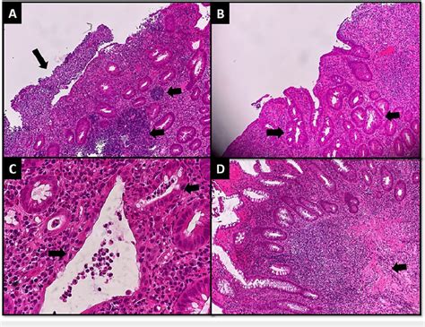 Endoscopic Bowel Biopsy At Eileen Perry Blog