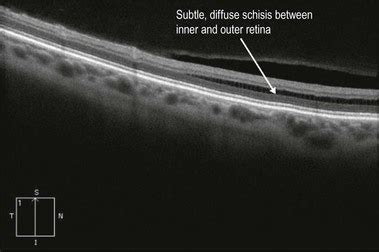 Retinoschisis Clinical Gate
