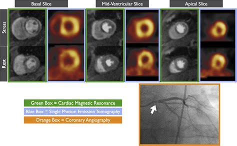 Stress Cardiac Magnetic Resonance Myocardial Perfusion Imaging Jacc