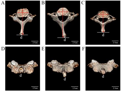 Cervical Vertebrae Anatomy C7