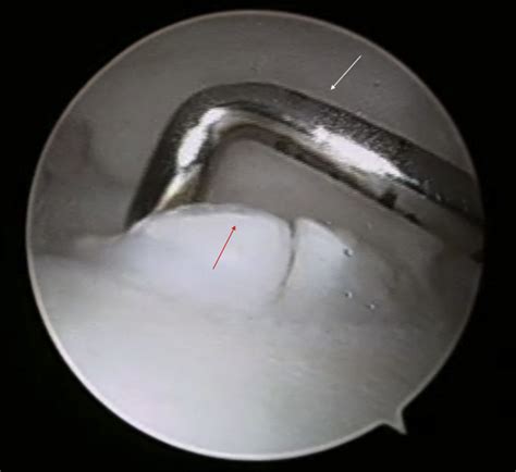 Ankle Arthroscopy With Microfracture For Osteochondral Defects Of The Talus Pmc