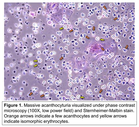 Cells In Urine Sediment Chart Urine Sediment Of The Month Fat Oval