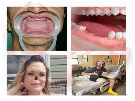 01 Introduction And Classification Partial Denturepptx Dental