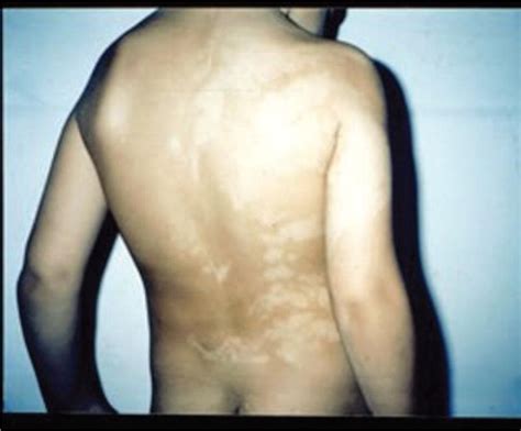 Hypopigmentation Back