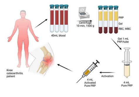 Prp Knee Joint Injections Dr St Aesthetics And Medical Clinic