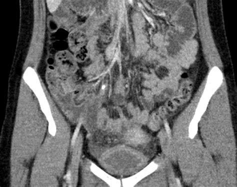 Acute Appendicitis Radiology Case Collection