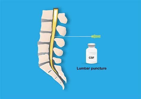 Lumbar Puncture Procedure Illustration 51125617 Vector Art At Vecteezy