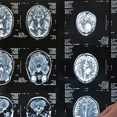 Brain Tumor Dataset Anonymized Kaggle