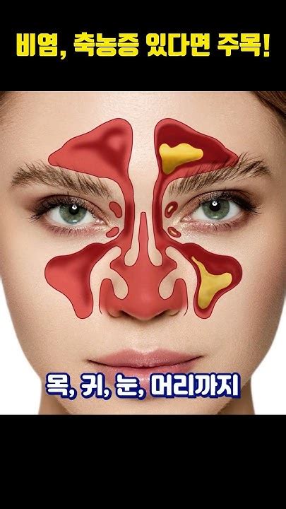 찐든찐득한 콧물 코막힘 있는 비염 주목 Shorts 배농치료 Youtube